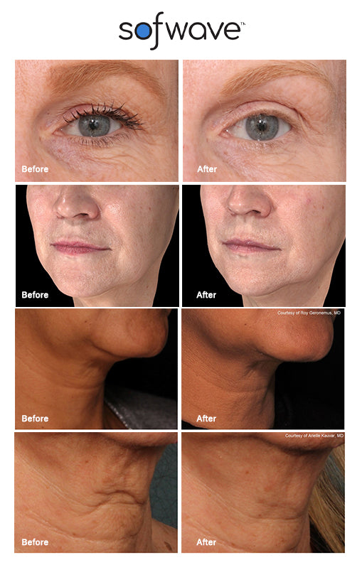 Sofwave™ – Nature Derma™